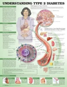 understanding type 2 diabetes anatomical chart