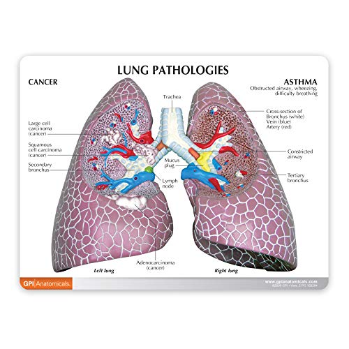 Lung Model Set | Human Body Anatomy Replica of Lung Cancer for Doctors Office Educational Tool | GPI Anatomicals