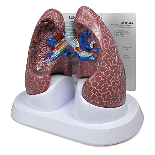 Lung Model Set | Human Body Anatomy Replica of Lung Cancer for Doctors Office Educational Tool | GPI Anatomicals