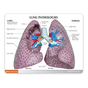 Lung Model Set | Human Body Anatomy Replica of Lung Cancer for Doctors Office Educational Tool | GPI Anatomicals