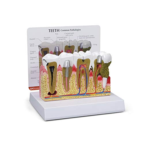 Dental Model | Human Body Anatomy Replica of Teeth w/Common Pathologies for Dentist Office Educational Tool | GPI Anatomicals