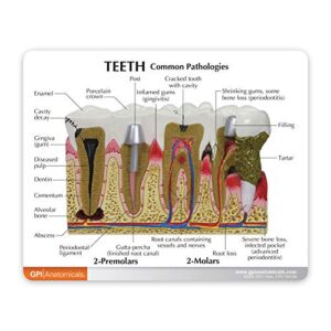 Dental Model | Human Body Anatomy Replica of Teeth w/Common Pathologies for Dentist Office Educational Tool | GPI Anatomicals