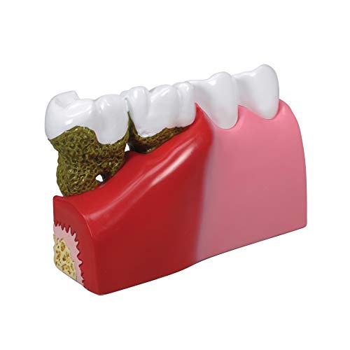 Dental Model | Human Body Anatomy Replica of Teeth w/Common Pathologies for Dentist Office Educational Tool | GPI Anatomicals