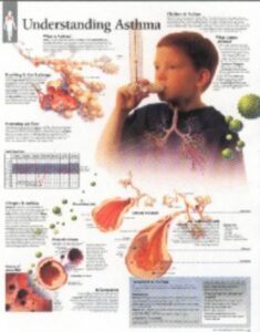 understanding asthma chart: laminated wall chart