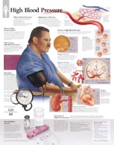 high blood pressure chart: wall chart