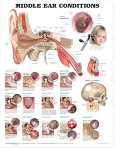 middle ear conditions anatomical chart