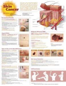 understanding skin cancer anatomical chart