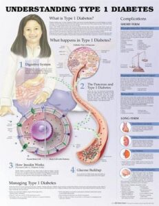 understanding type 1 diabetes anatomical chart