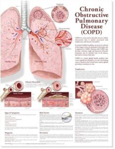 chronic obstructive pulmonary disease anatomical chart