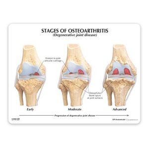 GPI Anatomicals Knee Joint Model Set | Human Body Anatomy Replica Set of 4-Stage Osteoarthritis Knee Joint for Doctors Office Educational Tool