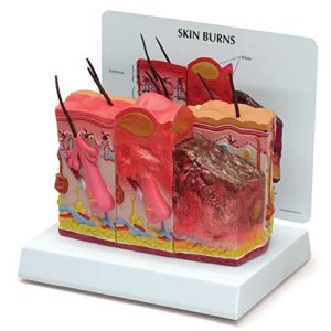 skin burn model | human body anatomy replica of varying degrees of skin burn for dermatology educational tool | gpi anatomicals