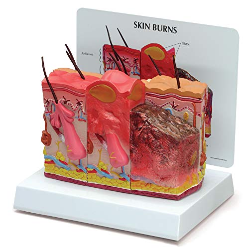 Skin Burn Model | Human Body Anatomy Replica of Varying Degrees of Skin Burn for Dermatology Educational Tool | GPI Anatomicals