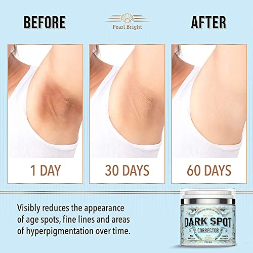 PearlBright Dark Spot Remover for Face, Body and Sensitive Areas - Natural Skincare for Underarms, Elbows & Privates - Made in USA - Dark Spot Corrector with Licorice, Mulberry Extract Arbutin, 1.7OZ