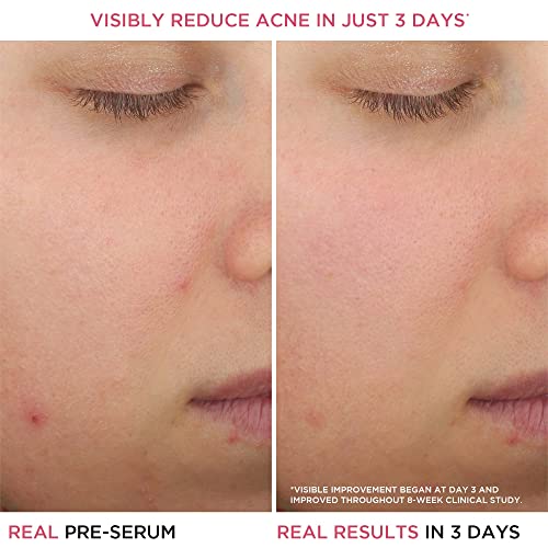 IT Cosmetics Bye Bye Breakout 2% Salicylic Acid Acne Treatment Serum, Helps Reduce Pimples in 3 Days & Fades Look of Post-Acne Marks in 8 Weeks, Facial Skin Care Product with 3% Lactic Acid - 1 fl oz