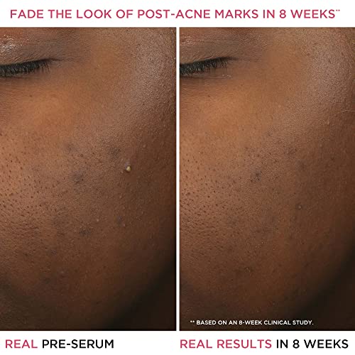 IT Cosmetics Bye Bye Breakout 2% Salicylic Acid Acne Treatment Serum, Helps Reduce Pimples in 3 Days & Fades Look of Post-Acne Marks in 8 Weeks, Facial Skin Care Product with 3% Lactic Acid - 1 fl oz