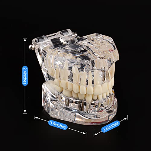 Ultrassist Transparent Disease Teeth Model with Dental Implant Bridge, Dental Model for Patient and Dental Student Education