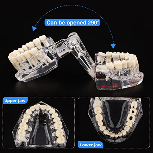 Ultrassist Transparent Disease Teeth Model with Dental Implant Bridge, Dental Model for Patient and Dental Student Education