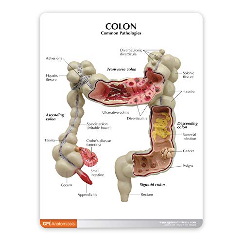 Colon Model | Human Body Anatomy Replica of Colon w/Common Pathologies for Doctors Office Educational Tool | GPI Anatomicals