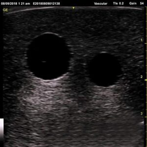 Ultrasound Central Line Training Model - CVL Phantom for Practice