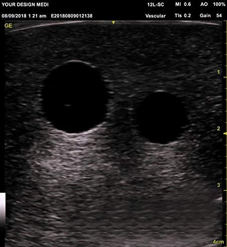 Ultrasound Central Line Training Model - CVL Phantom for Practice