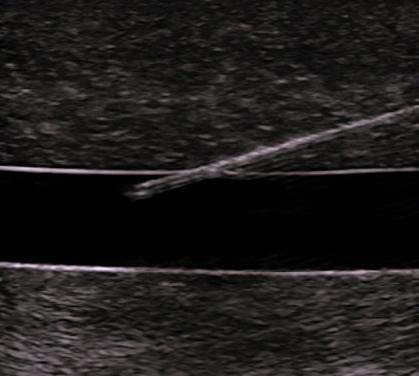 Ultrasound Central Line Training Model - CVL Phantom for Practice