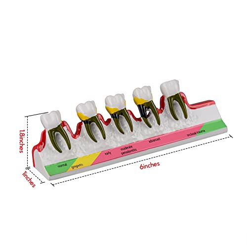 Ultrassist Dental Periodontal Disease Model, Dental Teeth Model for Dental Tooth Anatomy Study, Doctor-Patient and Oral Care Education