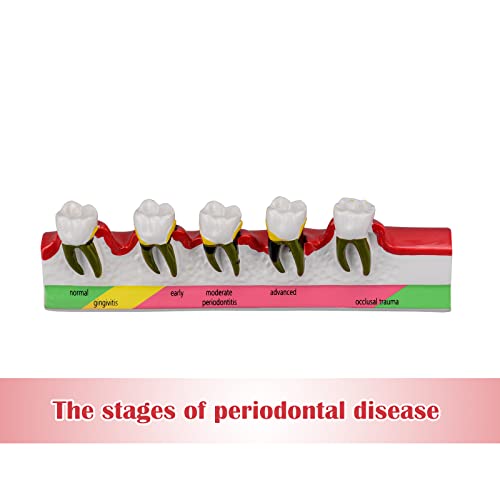 Ultrassist Dental Periodontal Disease Model, Dental Teeth Model for Dental Tooth Anatomy Study, Doctor-Patient and Oral Care Education