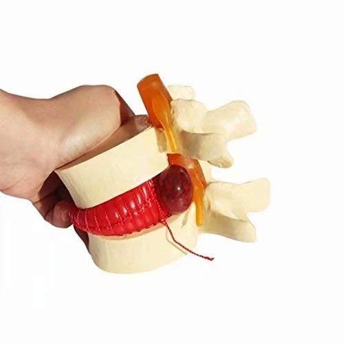 Human Lumbar Disc Herniation Demonstration Model Human Spine Anatomical Model Yellow