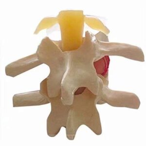 Human Lumbar Disc Herniation Demonstration Model Human Spine Anatomical Model Yellow