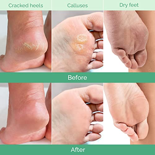 PLANTIFIQUE Foot Peel Mask with Peach 1 Pack Peeling Foot Mask Dermatologically Tested - Repairs Heels & Removes Dry Dead Skin for Baby Soft Feet - Exfoliating Mask for Dry Cracked Feet