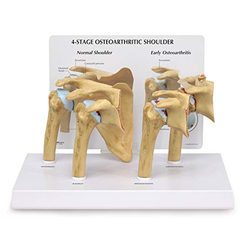 GPI Anatomicals Shoulder Joint Model Set | Human Body Anatomy Replica Set of 4-Stage Osteoarthritis Shoulder Joint for Doctors Office Educational Tool