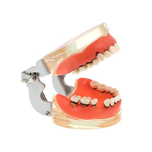 Dental Teeth Typodonts Model for Parodontopathy Periodontal Disease, Removable Gingivae Pathology Teeth Model Used in Teaching,Explain,Studying for Adult(Transparent)