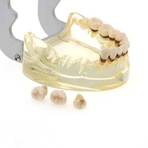 Dental Teeth Typodonts Model for Parodontopathy Periodontal Disease, Removable Gingivae Pathology Teeth Model Used in Teaching,Explain,Studying for Adult(Transparent)