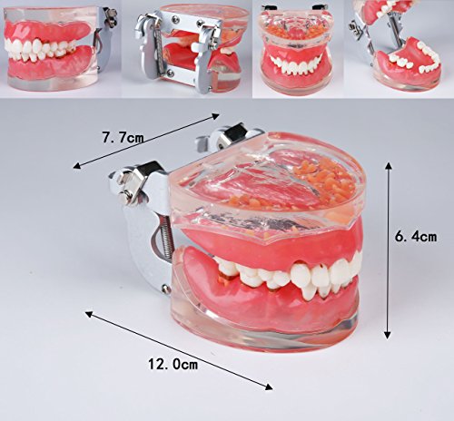 Dental Teeth Typodonts Model for Parodontopathy Periodontal Disease, Removable Gingivae Pathology Teeth Model Used in Teaching,Explain,Studying for Adult(Transparent)