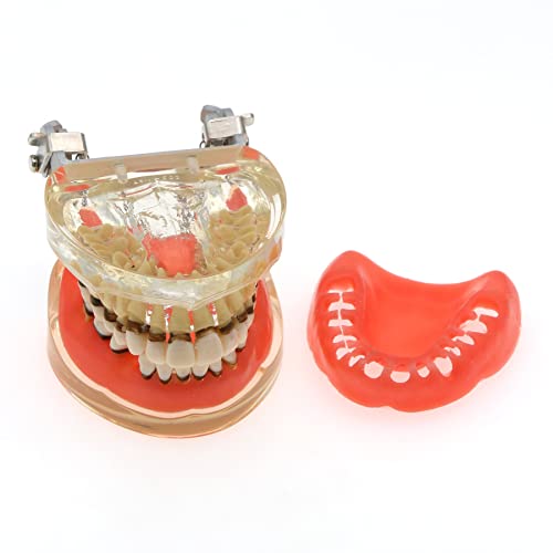 Dental Teeth Typodonts Model for Parodontopathy Periodontal Disease, Removable Gingivae Pathology Teeth Model Used in Teaching,Explain,Studying for Adult(Transparent)