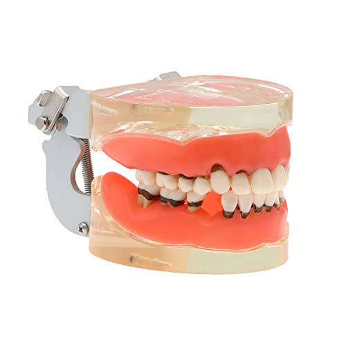 Dental Teeth Typodonts Model for Parodontopathy Periodontal Disease, Removable Gingivae Pathology Teeth Model Used in Teaching,Explain,Studying for Adult(Transparent)