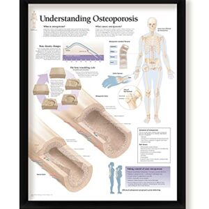 Set of 3 Framed Medical Posters Osteoarthritis Rheumatoid Arthritis Understanding Osteoporosis 22"x28" Wall Diagrams Educational Informational Doctors Office Rheumatology Charts