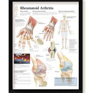 Set of 3 Framed Medical Posters Osteoarthritis Rheumatoid Arthritis Understanding Osteoporosis 22"x28" Wall Diagrams Educational Informational Doctors Office Rheumatology Charts