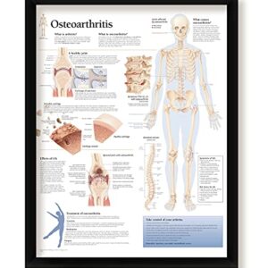 Set of 3 Framed Medical Posters Osteoarthritis Rheumatoid Arthritis Understanding Osteoporosis 22"x28" Wall Diagrams Educational Informational Doctors Office Rheumatology Charts