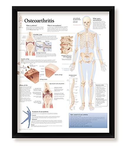 Set of 3 Framed Medical Posters Osteoarthritis Rheumatoid Arthritis Understanding Osteoporosis 22"x28" Wall Diagrams Educational Informational Doctors Office Rheumatology Charts