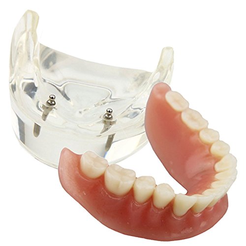 Smile1000 Dental Model Overdenture Inferior 2 Implants Demo for Studing and Teaching