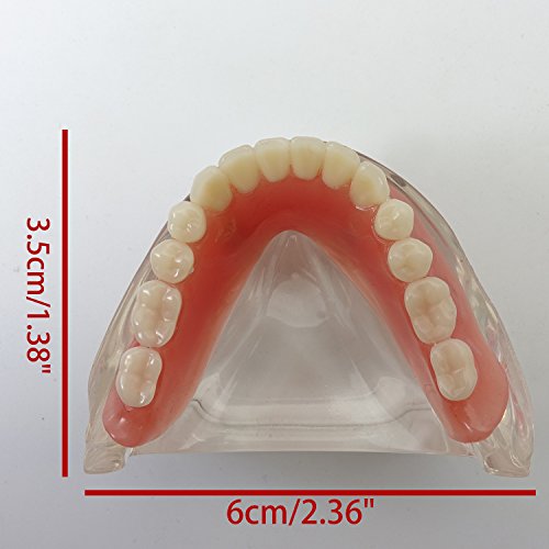 Smile1000 Dental Model Overdenture Inferior 2 Implants Demo for Studing and Teaching