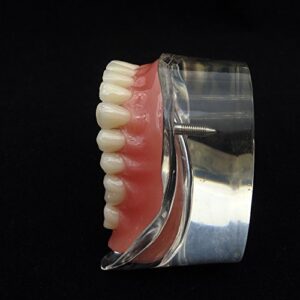 Smile1000 Dental Model Overdenture Inferior 2 Implants Demo for Studing and Teaching