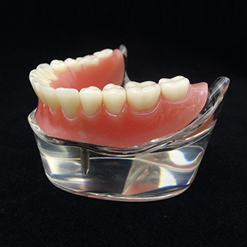 Smile1000 Dental Model Overdenture Inferior 2 Implants Demo for Studing and Teaching