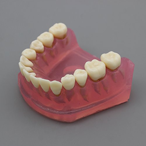 Dental Implant Teeth Model Study Teach Standard Model with Removable Teeth