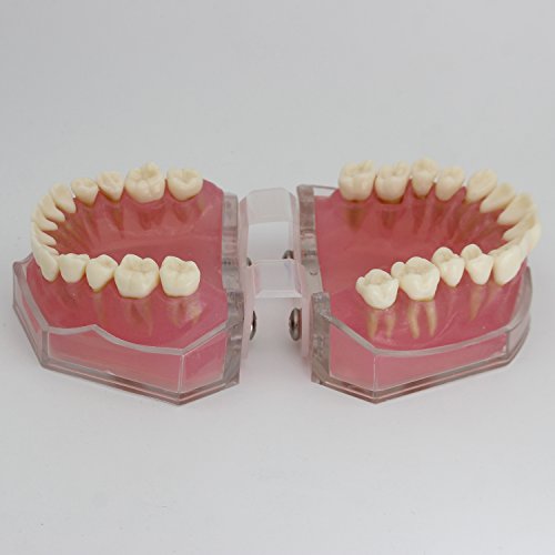 Dental Implant Teeth Model Study Teach Standard Model with Removable Teeth