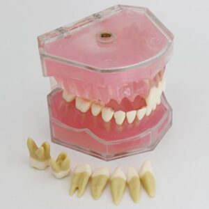 Dental Implant Teeth Model Study Teach Standard Model with Removable Teeth