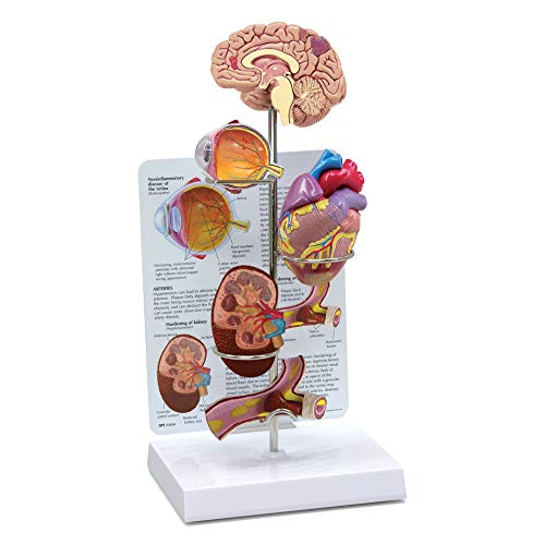 GPI Anatomicals - Hypertension Model Set | Human Body Anatomy Replica of The Effects from High Blood Pressure for Doctors Office Educational Tool