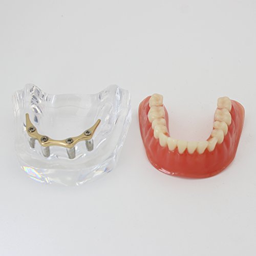 Dental Teeth Model Precision 4 Implant Overdenture Inferior Tooth Golden Color