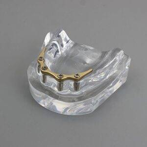 Dental Teeth Model Precision 4 Implant Overdenture Inferior Tooth Golden Color